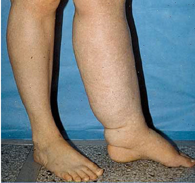 Lymfterapi Norrort AB » Lymfödem, primära och sekundära, samt om ...